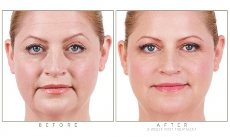 Dermal Fillers in Iran | Cosmetic & Skin Fillers | AriaMedTour