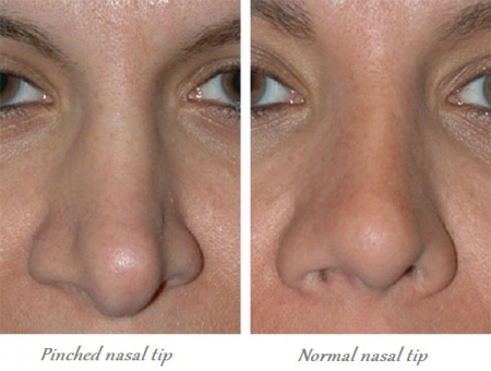 How To Tell If Someone Has Had a Nose Job? | AriaMedTour