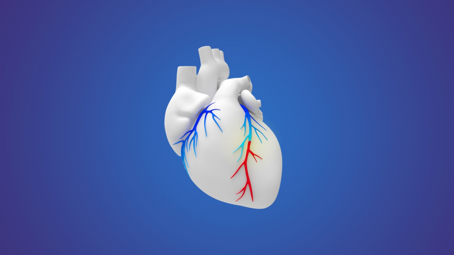 Open Heart Surgery in Iran | Affordable Cardiac Surgery | AriaMedTour