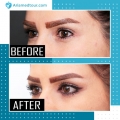Canthoplasty in Iran | Top Eyelid Surgeons | AriaMedTour