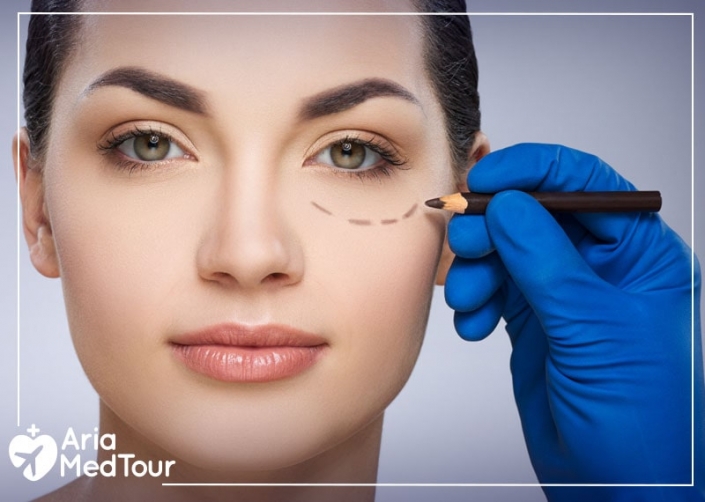 How Should I Prepare for Eyelid Surgery? (Blepharoplasty)