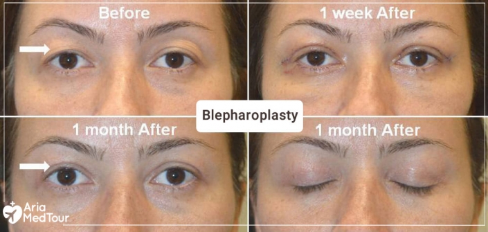 How Should I Prepare for Eyelid Surgery? (Blepharoplasty)