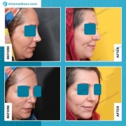 Forehead Contouring Before and After Photos (2022) - Iran | AriaMedTour