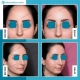 Forehead Contouring Before and After Photos (2022) - Iran | AriaMedTour