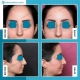 Forehead Contouring Before and After Photos (2022) - Iran | AriaMedTour