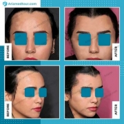 Forehead Contouring Before and After Photos (2022) - Iran | AriaMedTour