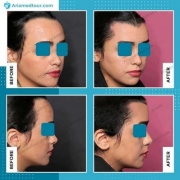 Forehead Contouring Before and After Photos (2022) - Iran | AriaMedTour