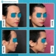 Forehead Contouring Before and After Photos (2022) - Iran | AriaMedTour