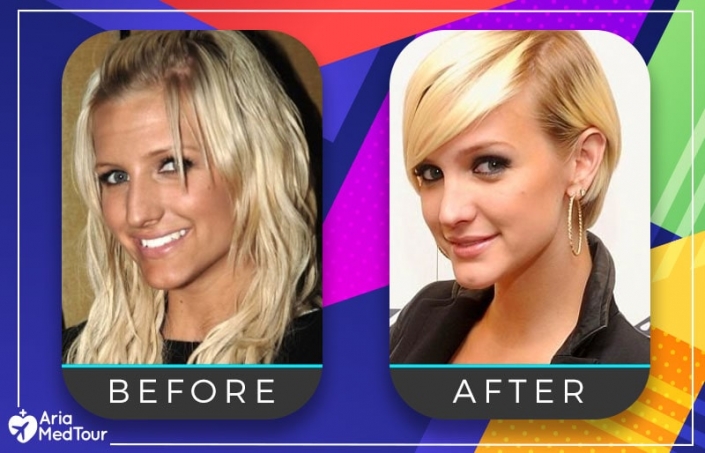 20 Celebs Who Admitted They Got Nose Job | AriaMedTour