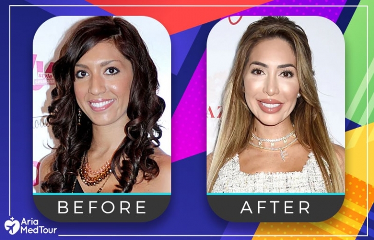 20 Celebs Who Admitted They Got Nose Job | AriaMedTour