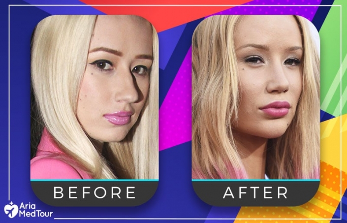 20 Celebs Who Admitted They Got Nose Job | AriaMedTour