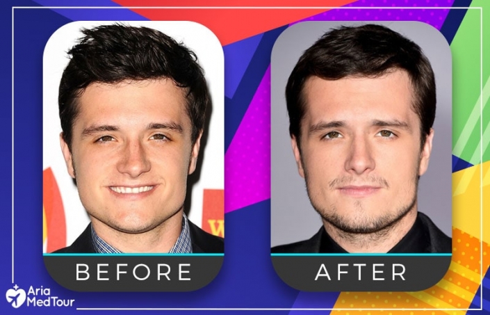 20 Celebs Who Admitted They Got Nose Job | AriaMedTour