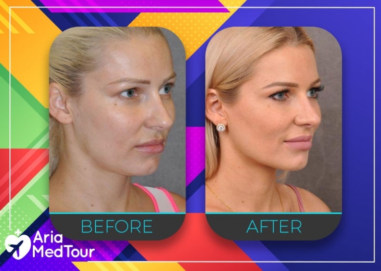 Best Non-Surgical Skin Tightening Procedures - AriaMedTour