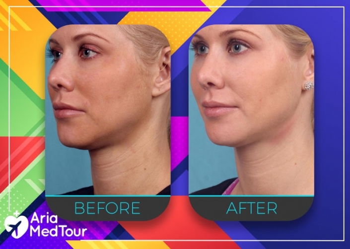 Best Non-Surgical Skin Tightening Procedures - AriaMedTour