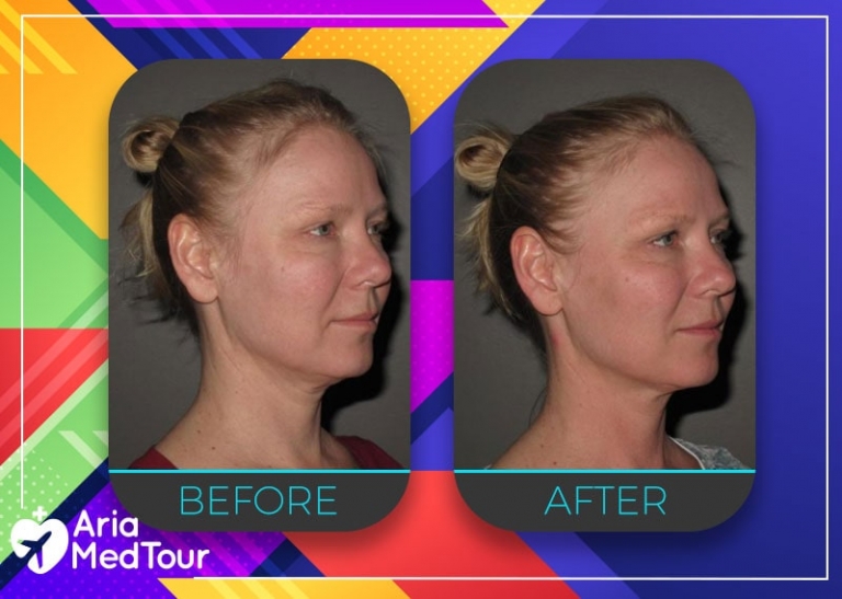 Best Non-Surgical Skin Tightening Procedures - AriaMedTour