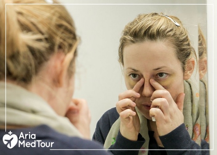 Everything You Need To Know About Bruising After Rhinoplasty