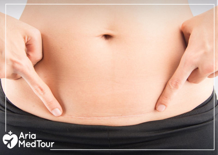 Speed up Your Tummy Tuck Recovery: A Comprehensive Guide