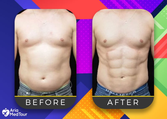 Abdominal Etching in Iran | Six Pack Surgery in Iran | AriaMedTour